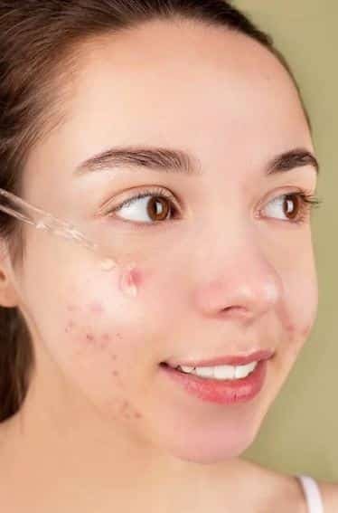 Hormonal Acne and Cystic Acne: Ultimate Guide – Ask The Nurse Expert
