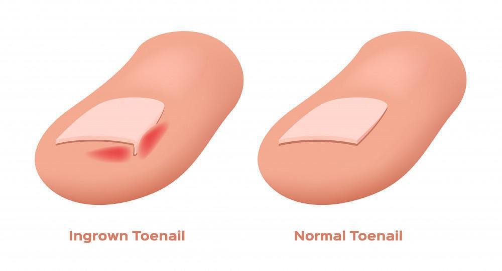 Causes And Symptoms Of An Ingrown Toenail - Ask The Nurse Expert