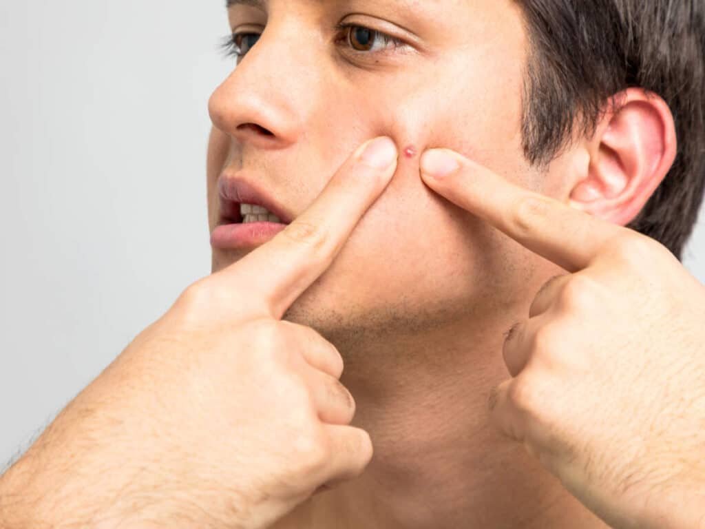 How to Get Rid of Zits – Ask The Nurse Expert