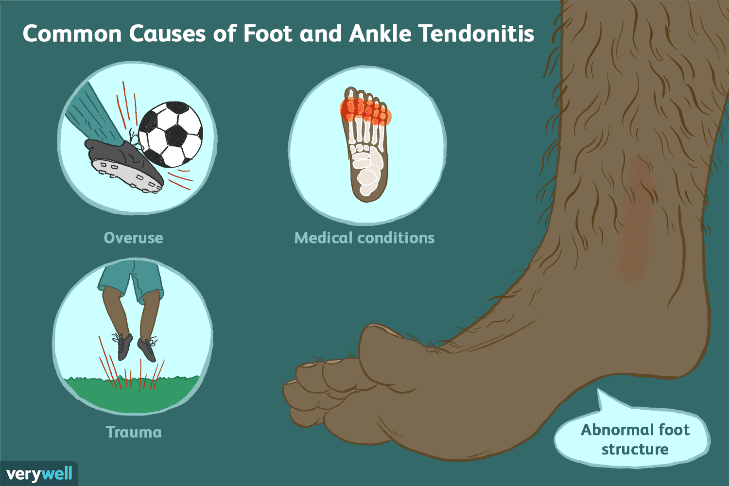 How To Prevent Tendonitis - Ask The Nurse Expert
