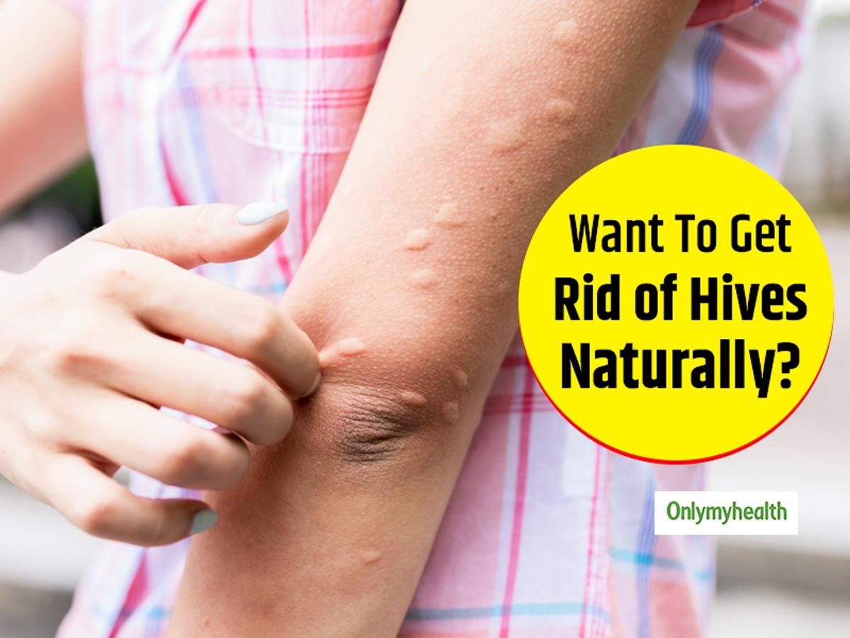 How To Treat Hives: Effective Remedies And Tips - Ask The Nurse Expert