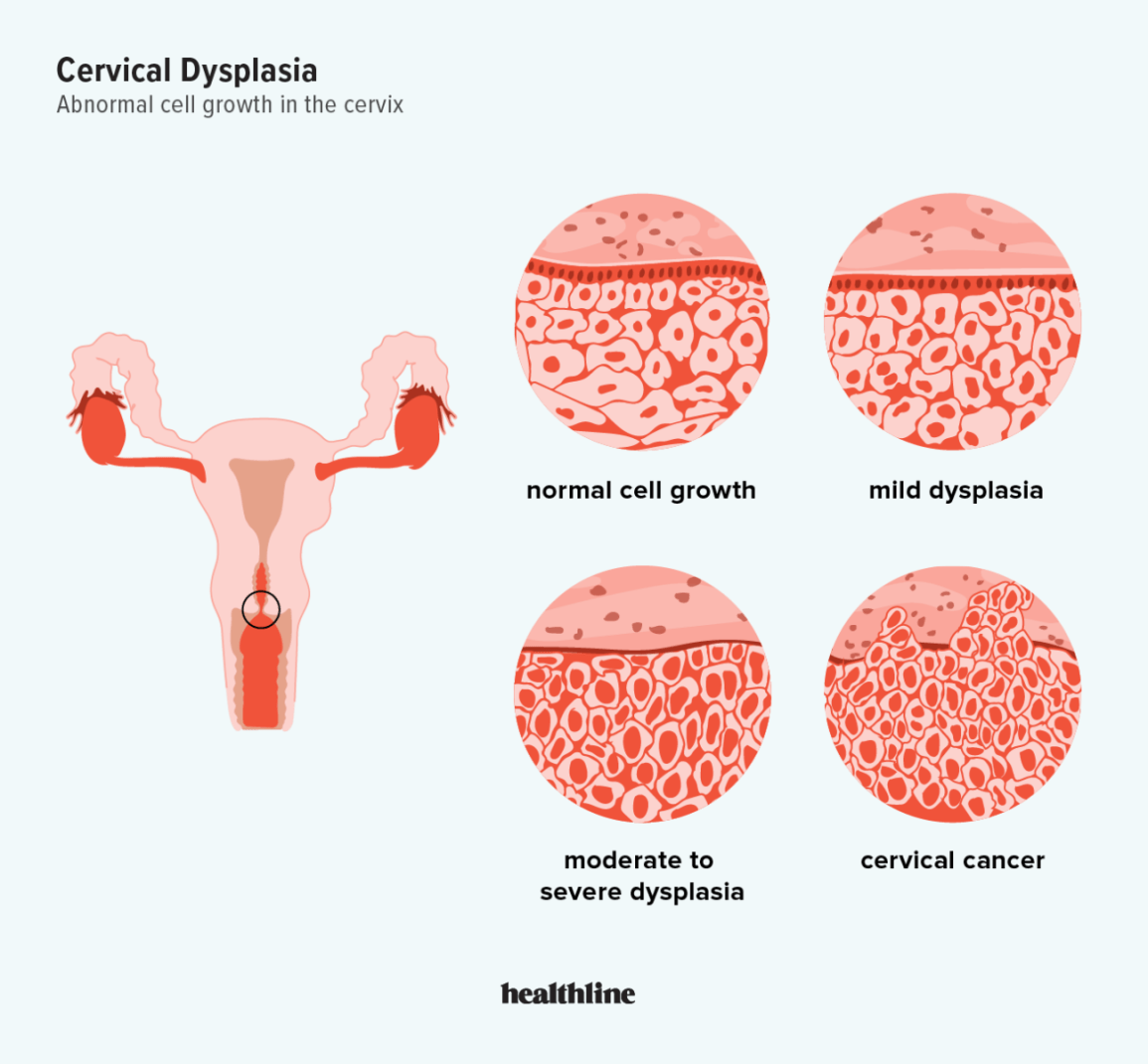 Living With Cervical Dysplasia: Coping Strategies And Support - Ask The ...