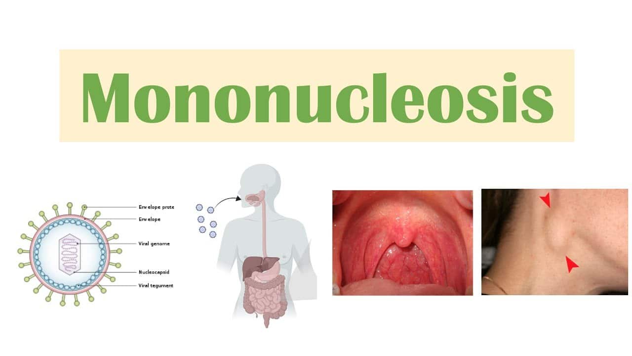 Mononucleosis In Children: What Parents Need To Know - Ask The Nurse Expert