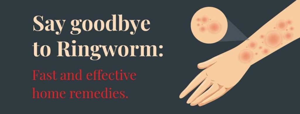 Natural Remedy For Ringworm - Ask The Nurse Expert