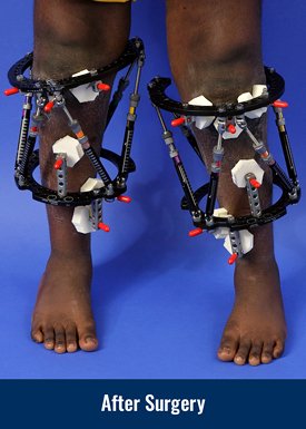 Nursing Considerations For Bow Legs - Ask The Nurse Expert