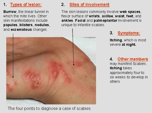 Nursing Considerations For Scabies Prevention - Ask The Nurse Expert