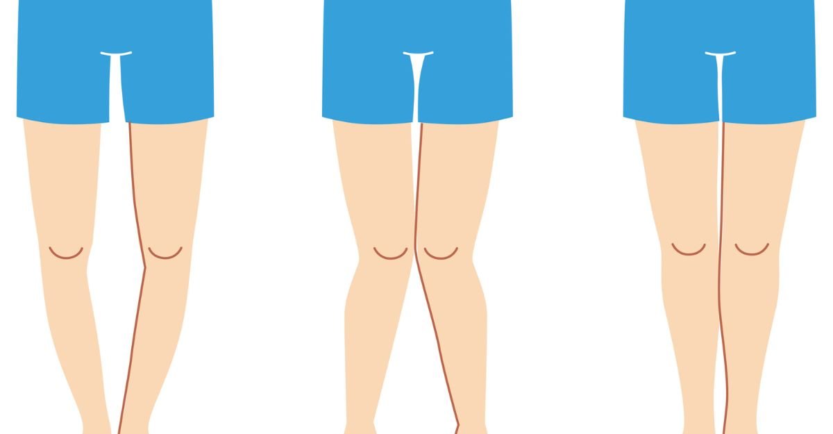 Risk Factors And Precautions For Bow Legs - Ask The Nurse Expert
