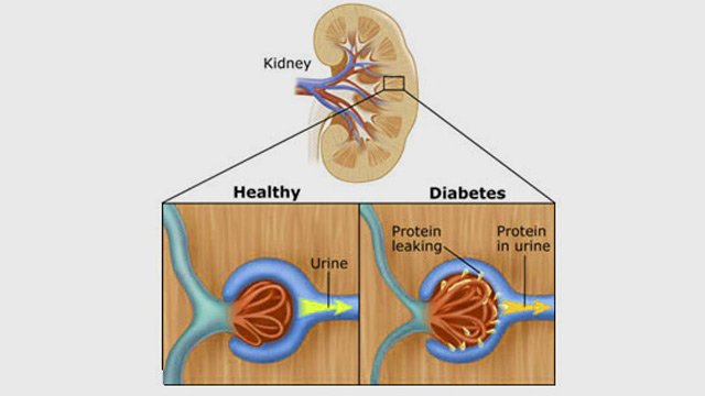 The Link Between Diabetes and Chronic Kidney Disease - Ask The Nurse Expert