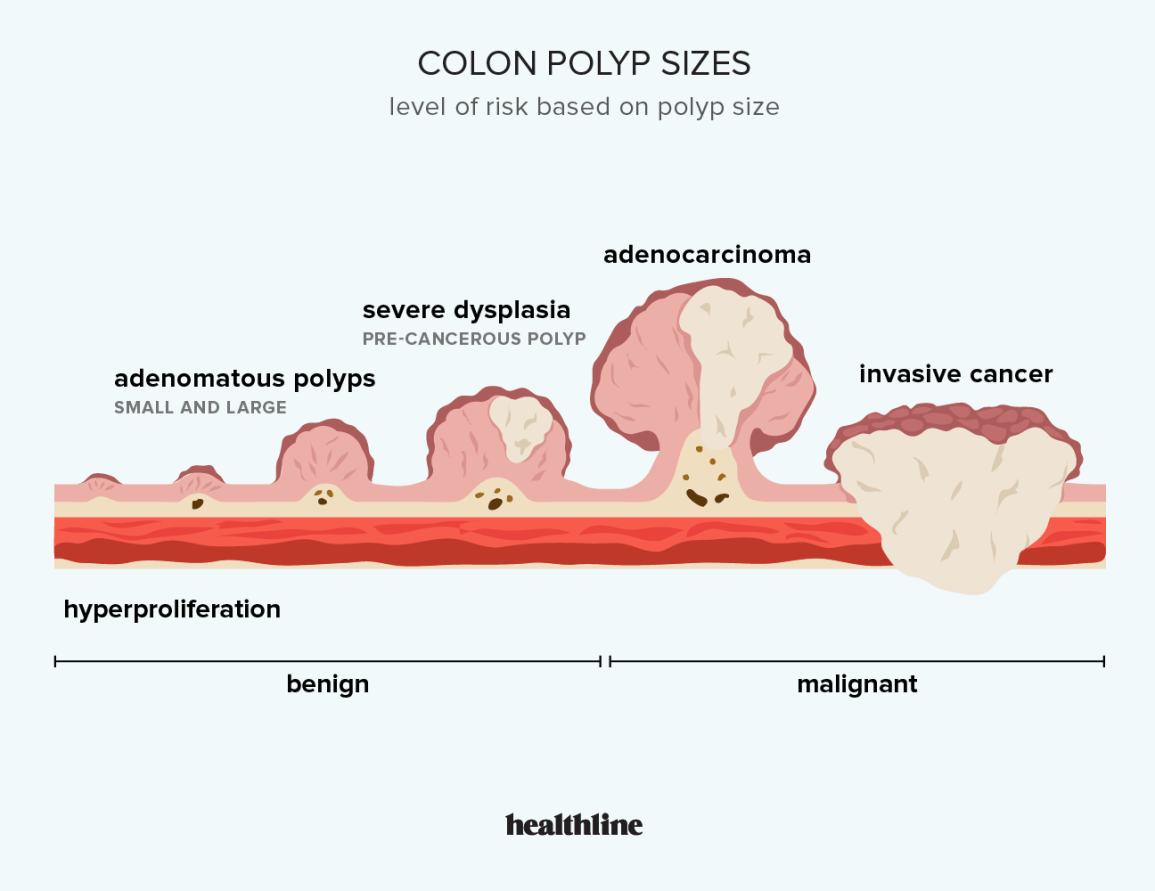 Types Of Bowel Polyps: A Comprehensive Overview - Ask The Nurse Expert