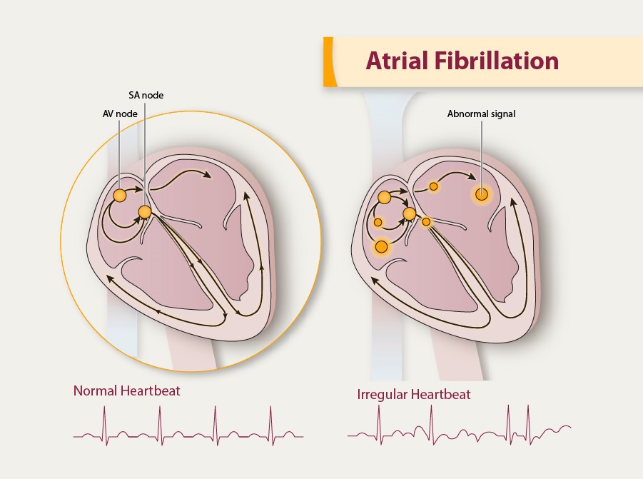 Understanding Atrial Fibrillation – Ask The Nurse Expert