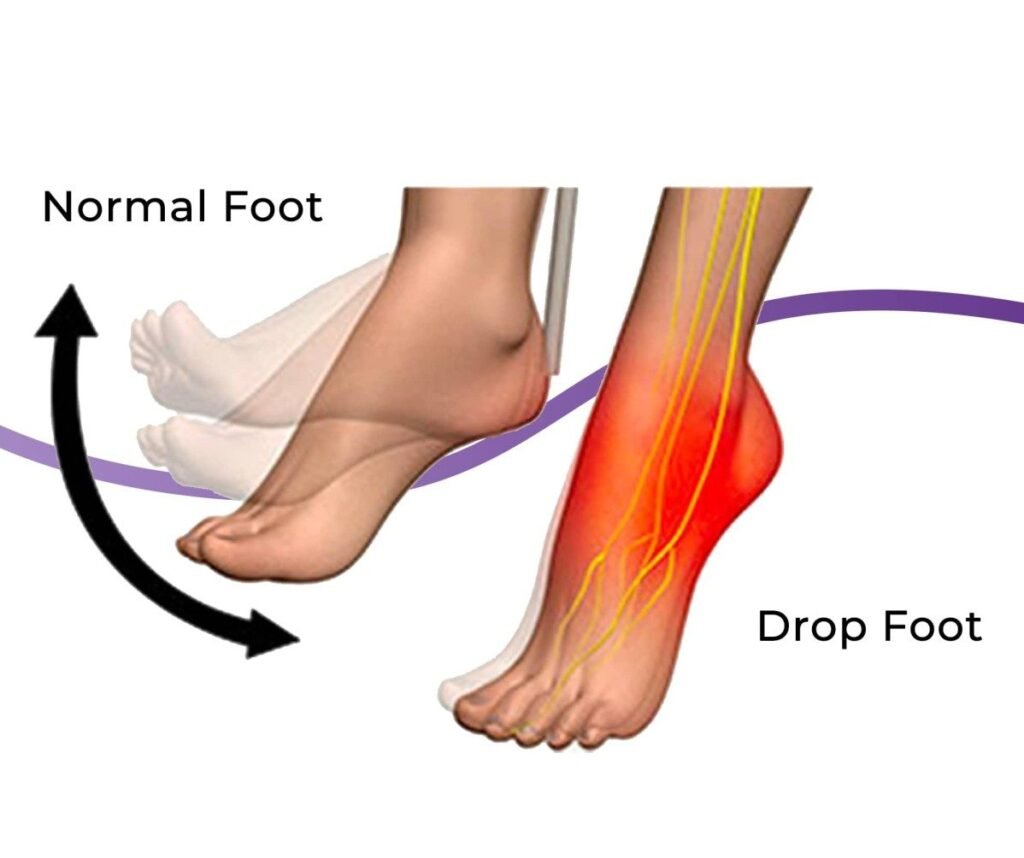 Understanding Foot Drop Ask The Nurse Expert Understanding Foot Drop Ask The Nurse Expert