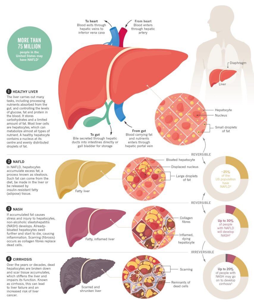 Understanding Liver Disease - Ask The Nurse Expert