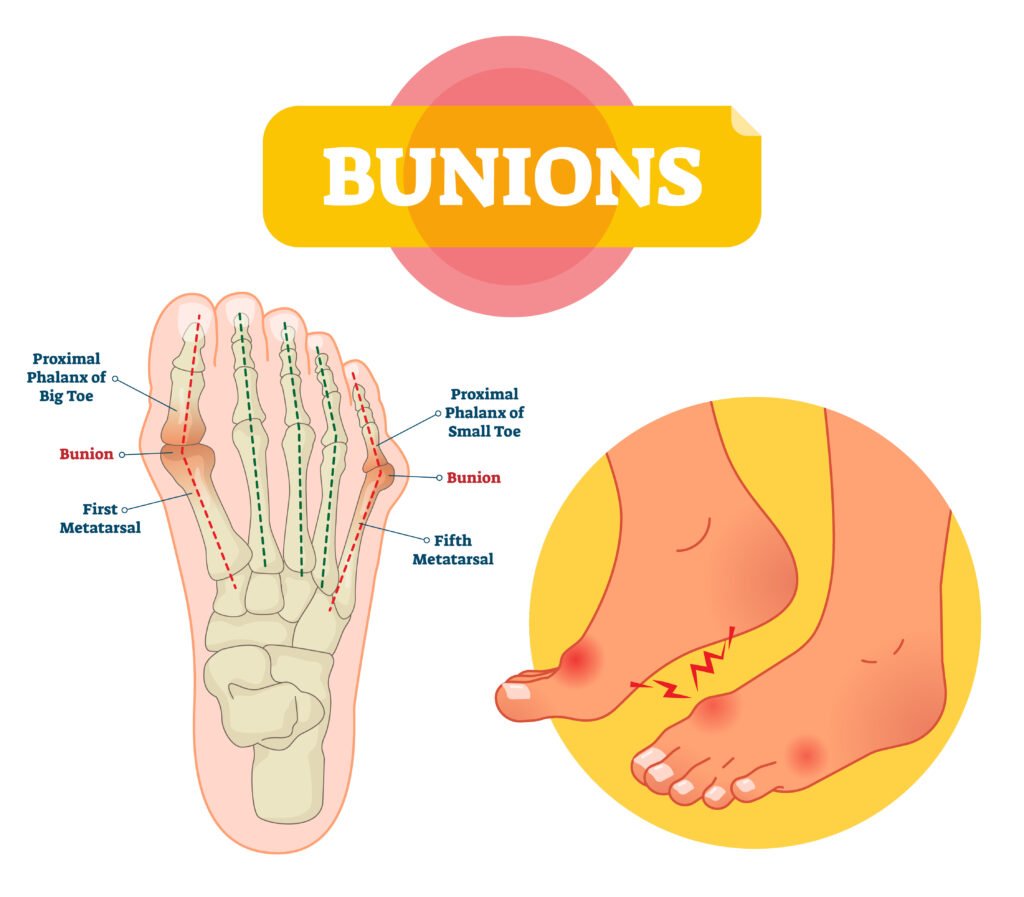 Understanding The Causes Of Bunions - Ask The Nurse Expert