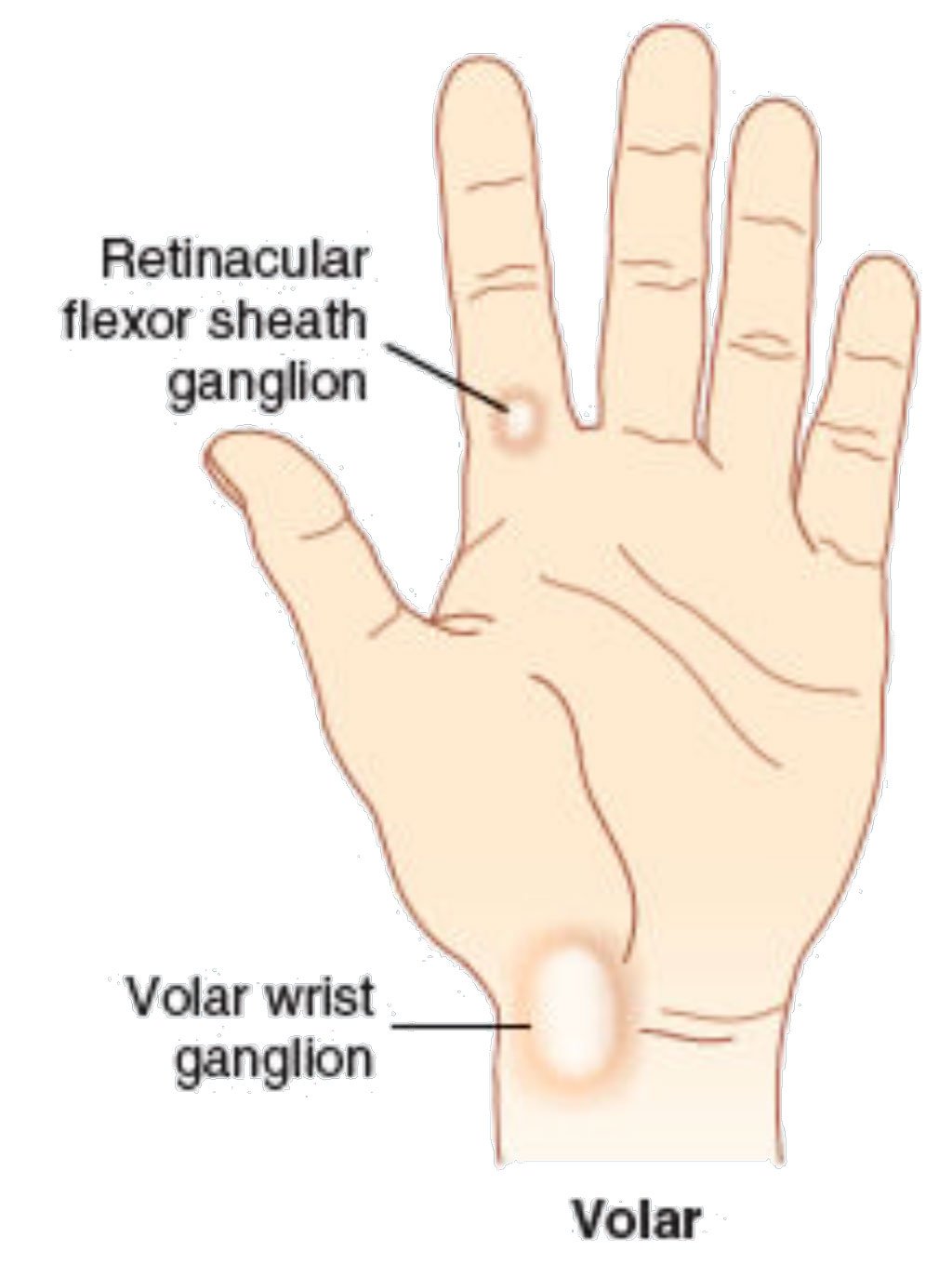 Unveiling Ganglion Cyst Complications: When To Seek Medical Attention ...