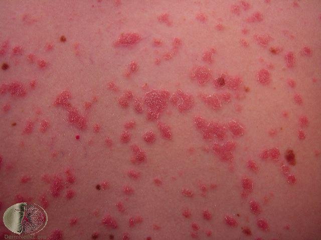 What Do Psoriasis Bumps Look Like? - Ask The Nurse Expert