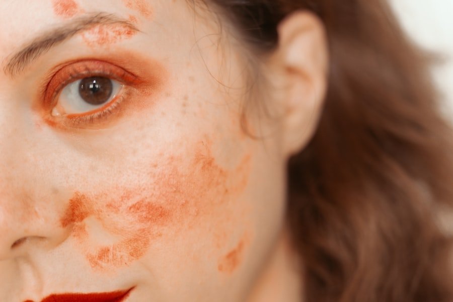 Prescription Acne Treatment Options